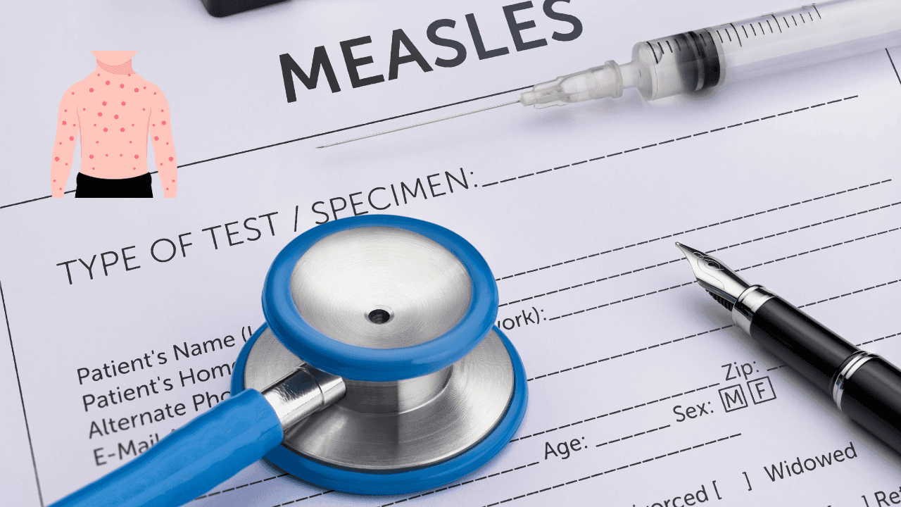Measles Through Time: From Past to Present, Exploring Causes, Symptoms ...
